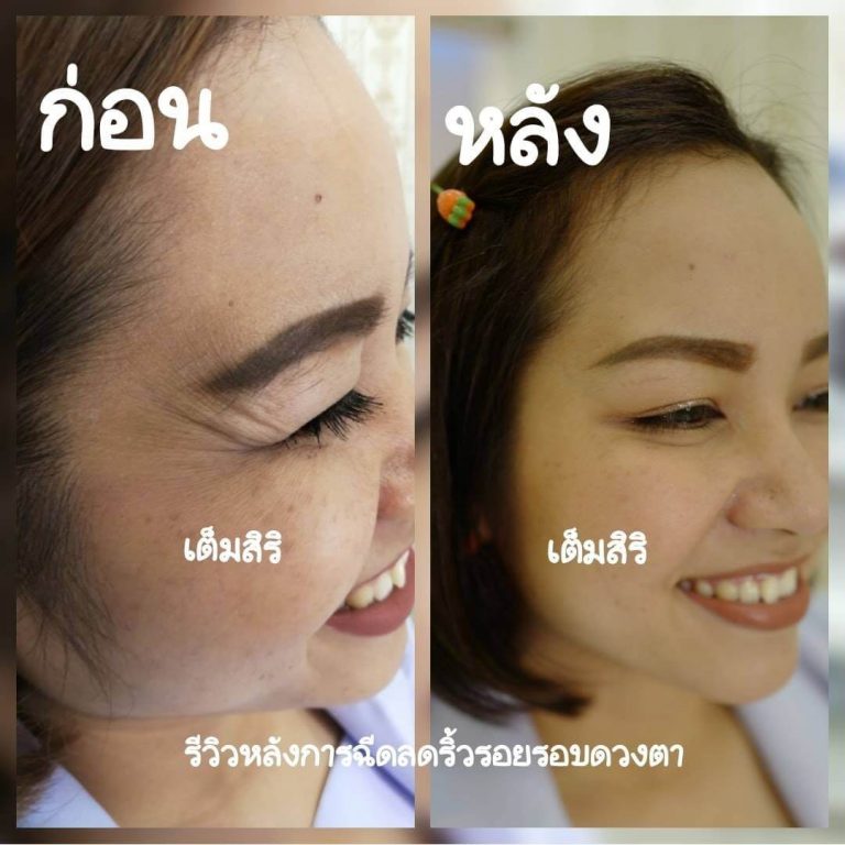 Vichen คืออะไรอะไรผลิตภัณฑ์ครีมแท้ราคารีวิวของซื้อที่ไหนวิธีนวดเทศไทย ...